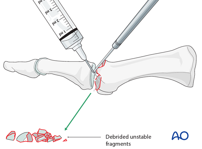 Arthrodesis of 1st MTP joint for Distal articular fractures of the 1st ...