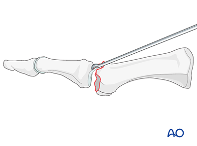Arthrodesis of 1st MTP joint for Distal articular fractures of the 1st ...