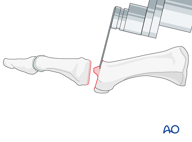 Arthrodesis of 1st MTP joint for Distal articular fractures of the 1st ...