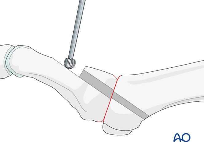 Arthrodesis of 1st MTP joint for Distal articular fractures of the 1st ...