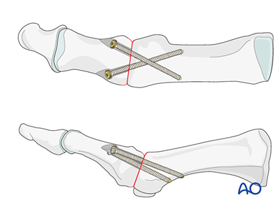 Arthrodesis of 1st MTP joint for Distal articular fractures of the 1st ...