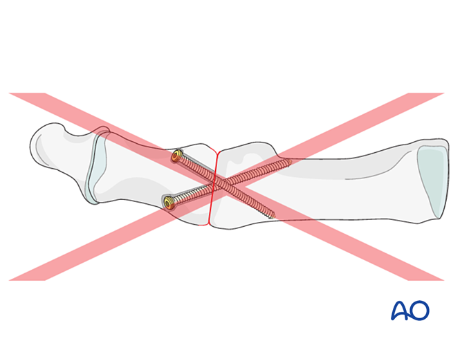 Arthrodesis of 1st MTP joint for Distal articular fractures of the 1st ...