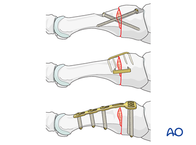 Arthrodesis of length stable proximal articular fractures of the 1st ...