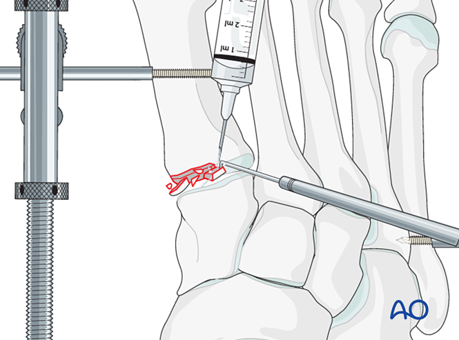 Arthrodesis of length stable proximal articular fractures of the 1st ...
