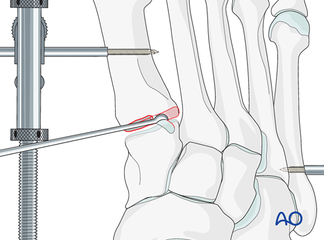 Arthrodesis of length stable proximal articular fractures of the 1st ...