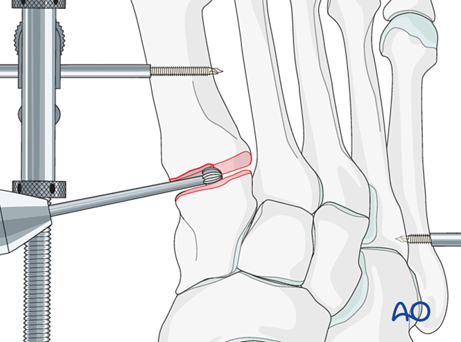 Arthrodesis of length stable proximal articular fractures of the 1st ...