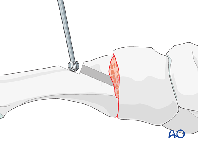 Arthrodesis of metatarsals 1–3 (length stable) for Proximal articular ...