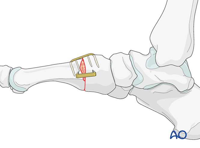 Arthrodesis of length stable proximal articular fractures of the 1st ...