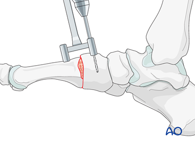 Arthrodesis of length stable proximal articular fractures of the 1st ...