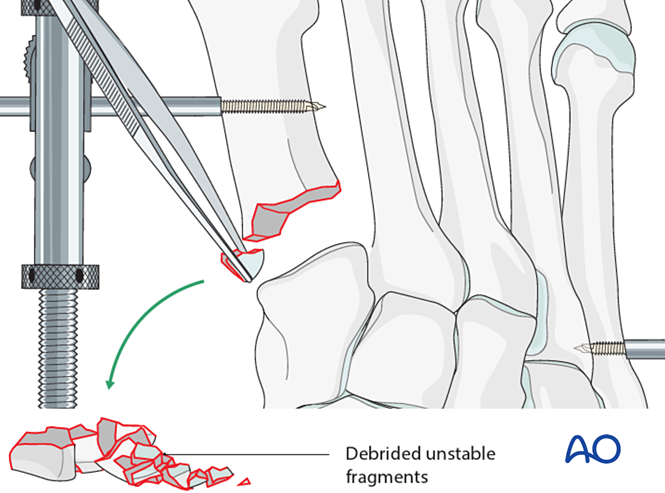 Arthrodesis of metatarsals 1–3 (length unstable) for Proximal articular ...