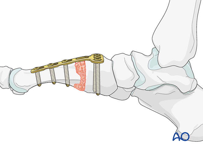 Arthrodesis of length unstable proximal articular fractures of the 1st ...