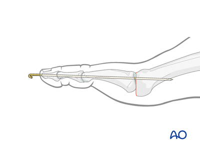 Excision arthroplasty for Distal fractures of the 5th metatarsal