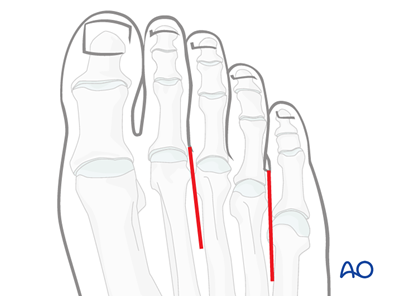 Excision arthroplasty for Distal articular fractures of the 1st to 4th ...