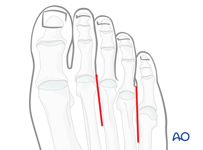 Excision arthroplasty for Distal articular fractures of the 1st to 4th ...
