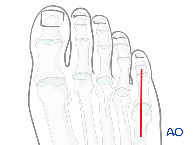 Excision arthroplasty for Distal fractures of the 5th metatarsal