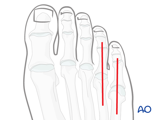 Excision arthroplasty for Distal fractures of the 5th metatarsal