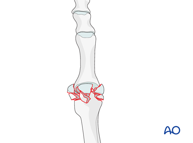 Excision arthroplasty for Distal fractures of the 5th metatarsal