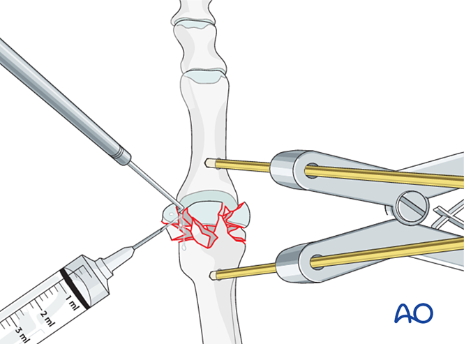 Excision arthroplasty for Distal articular fractures of the 1st to 4th ...