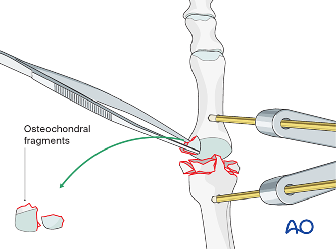 Excision arthroplasty for Distal articular fractures of the 1st to 4th ...