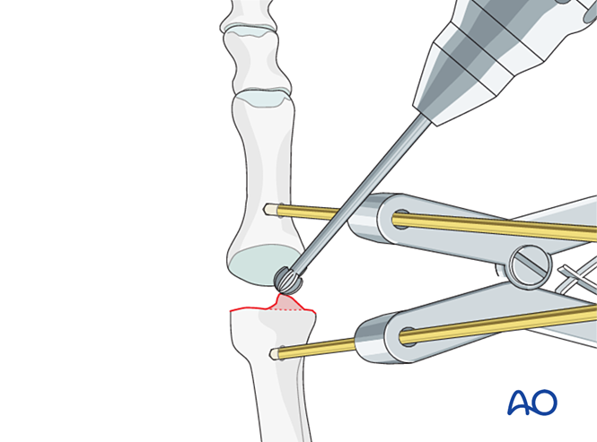 Excision arthroplasty for Distal articular fractures of the 1st to 4th ...
