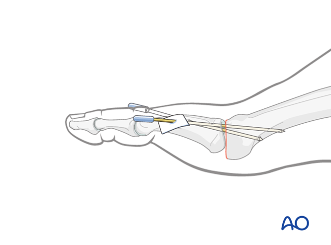 Excision arthroplasty for Distal fractures of the 5th metatarsal