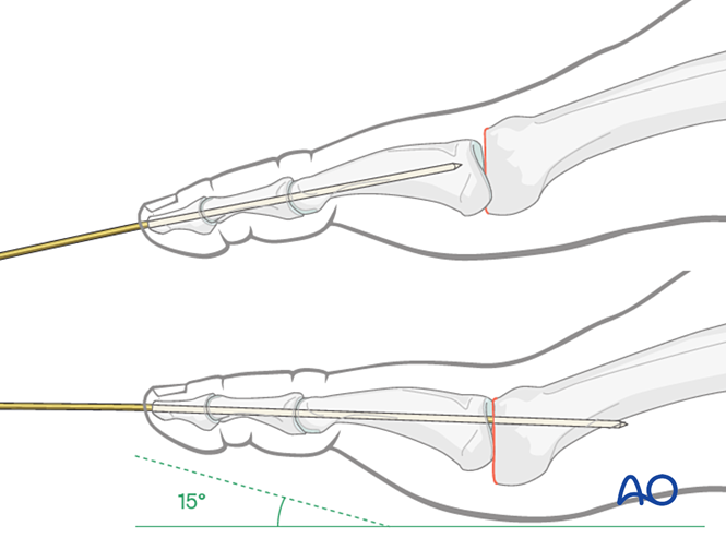 Excision arthroplasty for Distal fractures of the 5th metatarsal
