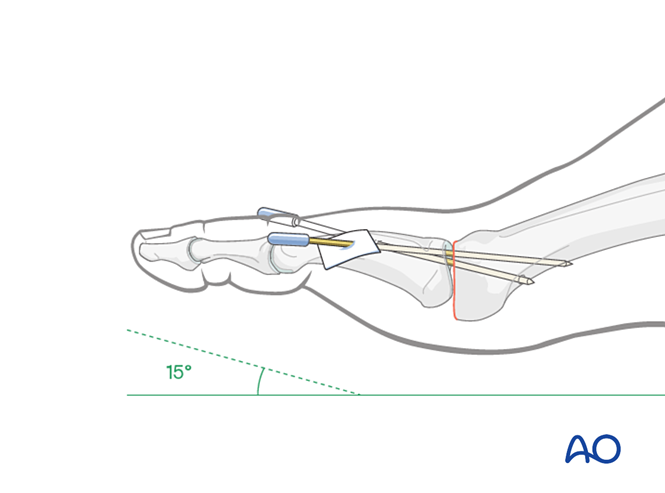 Excision arthroplasty for Distal fractures of the 5th metatarsal