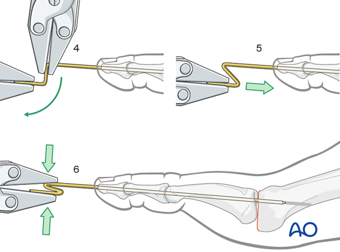 Excision arthroplasty for Distal fractures of the 5th metatarsal