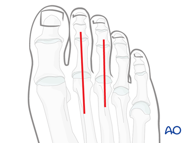 Excision arthroplasty for Distal articular fractures of the 1st to 4th ...