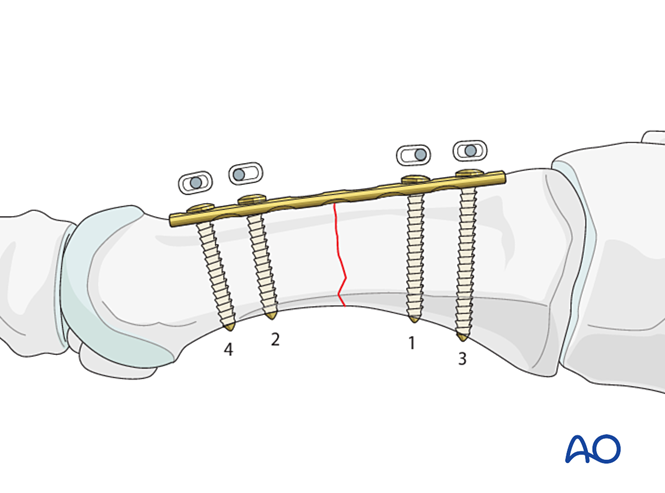 Compression plate fixation (straight plate) for Simple diaphyseal and ...