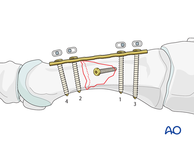 Compression plate fixation (straight plate) for Wedge diaphyseal and ...