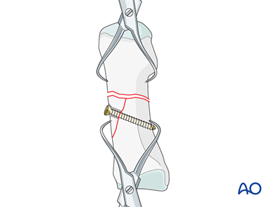 Compression plate fixation (straight plate) for Wedge diaphyseal and ...