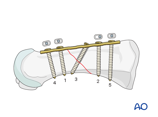 Compression plate fixation (straight plate) for Simple diaphyseal and ...