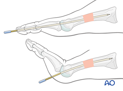 Intramedullary K-wire fixation for Simple diaphyseal and proximal ...