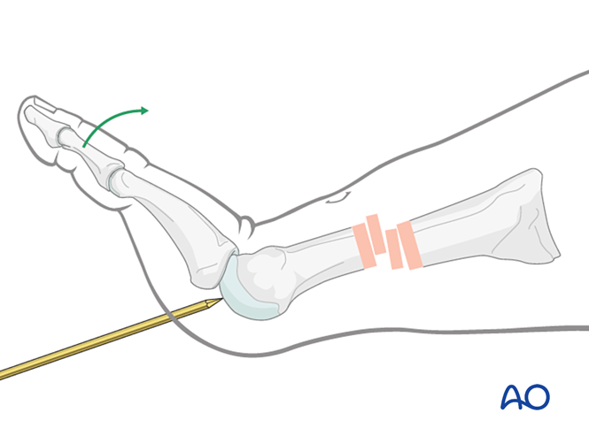 Intramedullary K Wire Fixation For Distal Extraarticular Fractures Of