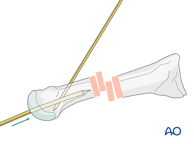 Intramedullary K-wire fixation for Distal extraarticular fractures of ...
