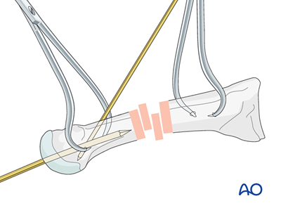 Intramedullary K-wire fixation for Distal extraarticular fractures of ...
