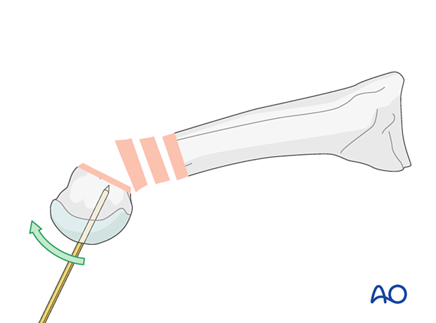Intramedullary K Wire Fixation For Distal Extraarticular Fractures Of