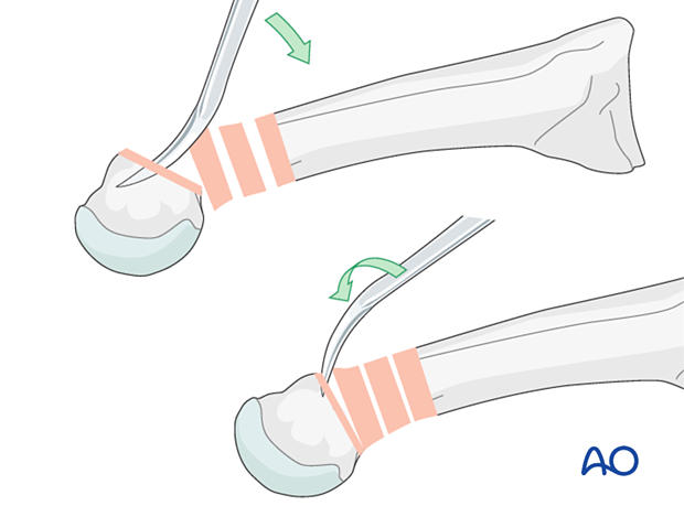 Intramedullary K Wire Fixation For Distal Extraarticular Fractures Of
