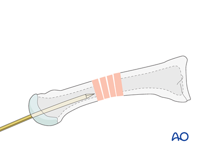 Intramedullary K-wire fixation for Multifragmentary diaphyseal and ...