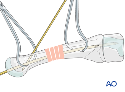 Intramedullary K-wire fixation for Distal extraarticular fractures of ...