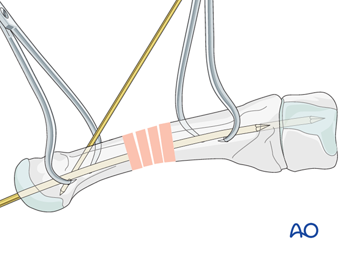Intramedullary K Wire Fixation For Distal Extraarticular Fractures Of