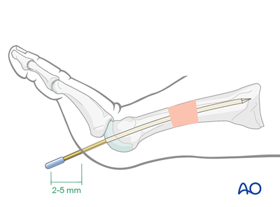 Intramedullary K-wire fixation for Distal extraarticular fractures of ...