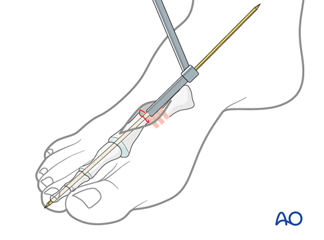 Intramedullary K-wire fixation for Distal extraarticular fractures of ...