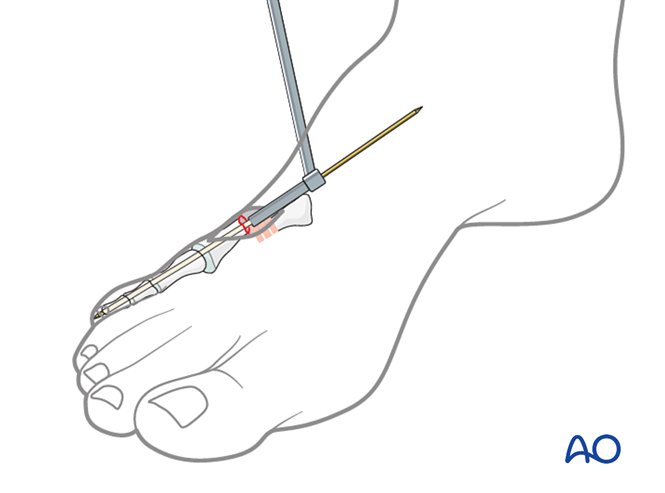 Intramedullary K-wire fixation for Distal fractures of the 5th metatarsal