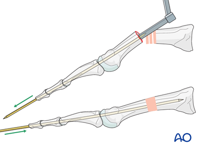 Intramedullary K-wire fixation for Distal fractures of the 5th metatarsal