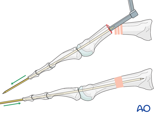 Intramedullary K Wire Fixation For Distal Extraarticular Fractures Of