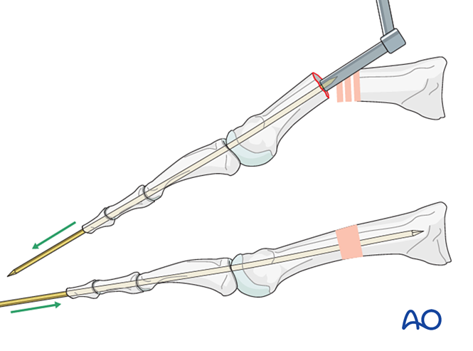 Intramedullary K-wire fixation for Distal extraarticular fractures of ...