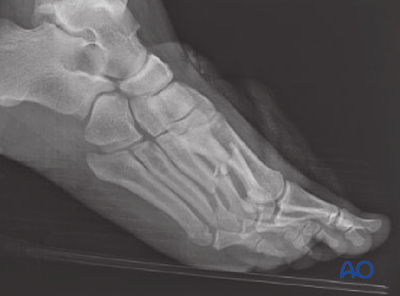 ORIF for Crush injuries