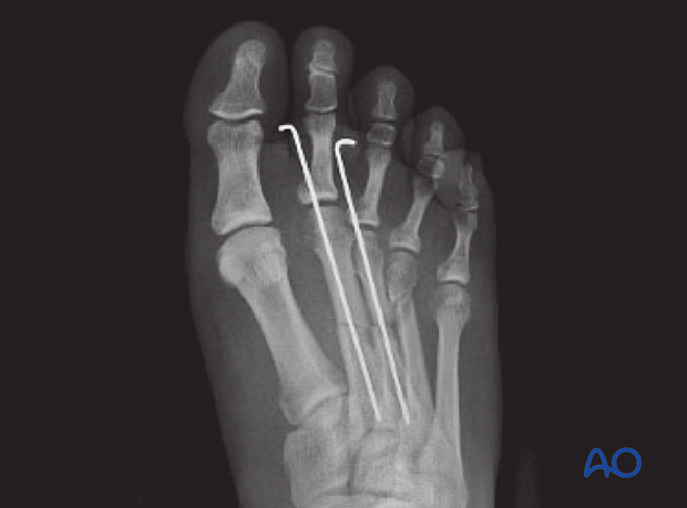 Intramedullary K Wire Fixation For Distal Extraarticular Fractures Of